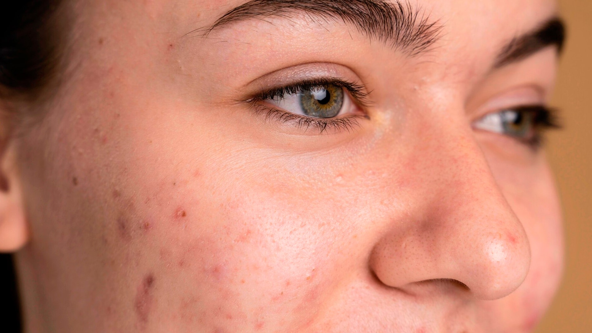 Eucerin DermoPure Triple Effect Serum Review - Bcare